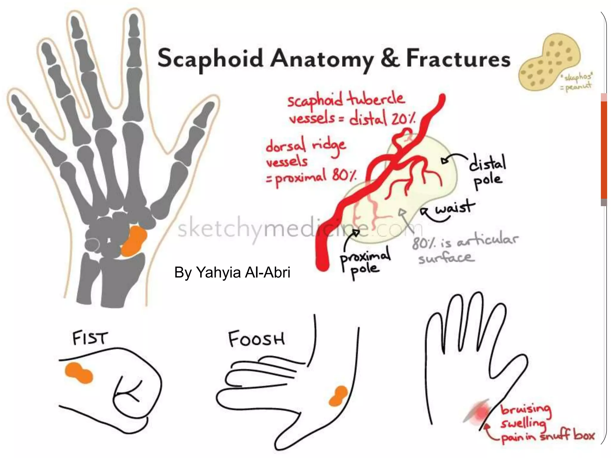 Scaphoid fractures | PPTX