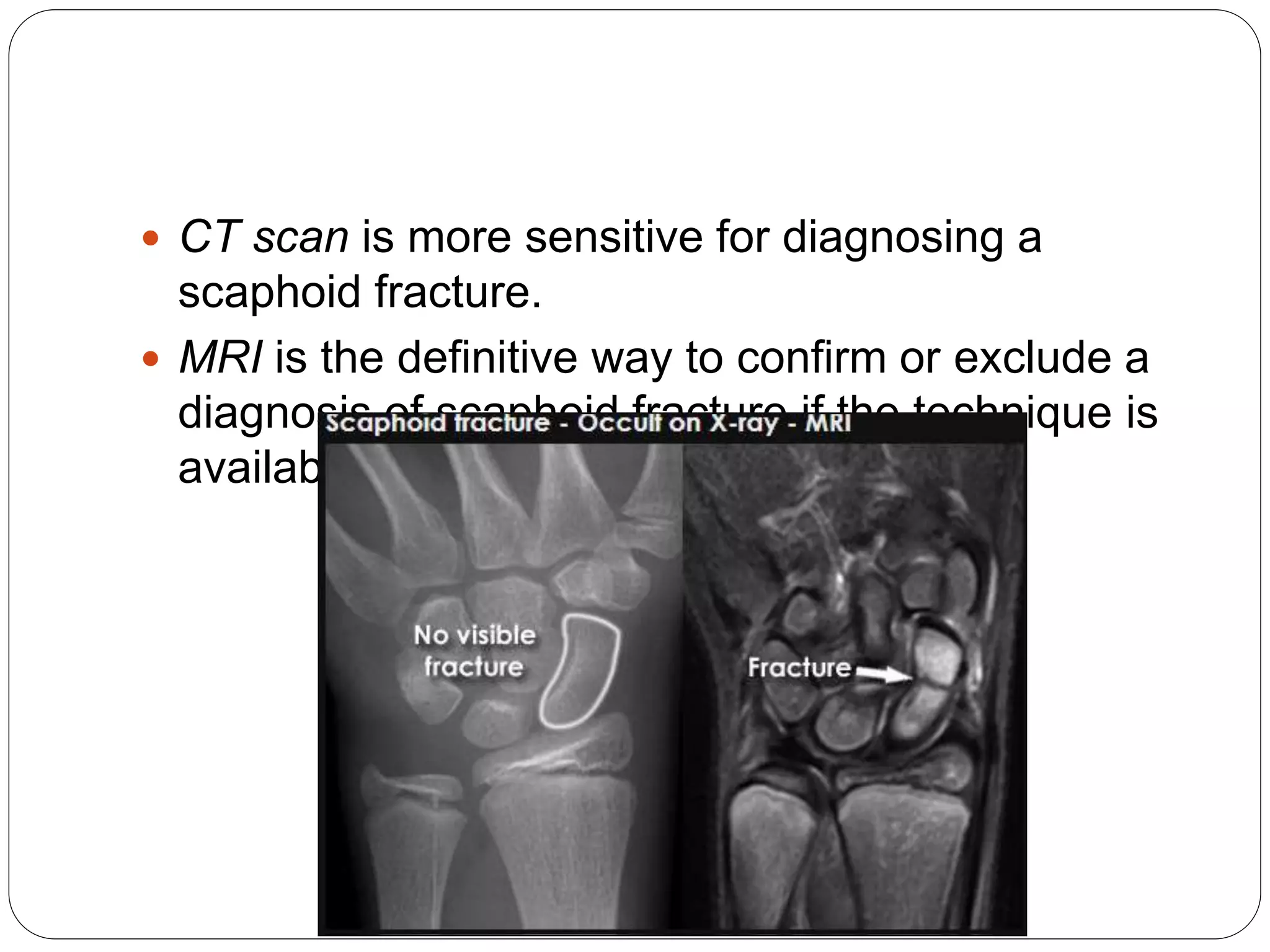 Scaphoid fractures | PPTX | Death, Injury, or Military Conflict ...