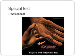 Scaphoid fractures | PPTX | Death, Injury, or Military Conflict ...