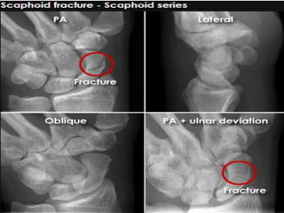 Scaphoid fractures | PPTX