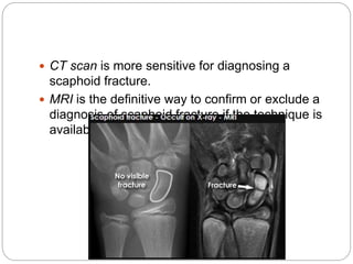 Scaphoid fractures | PPTX