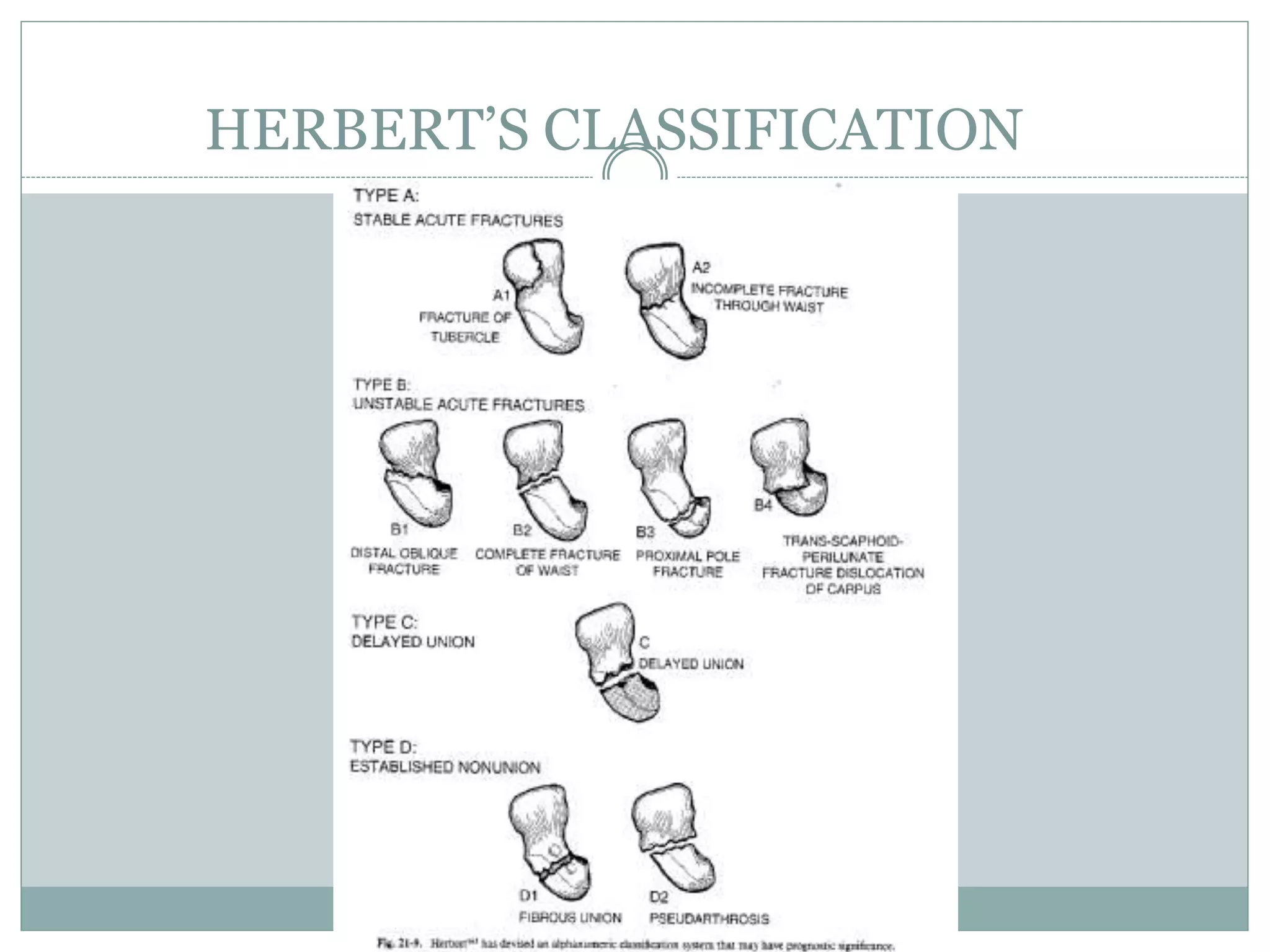 Scaphoid fractures | PPTX
