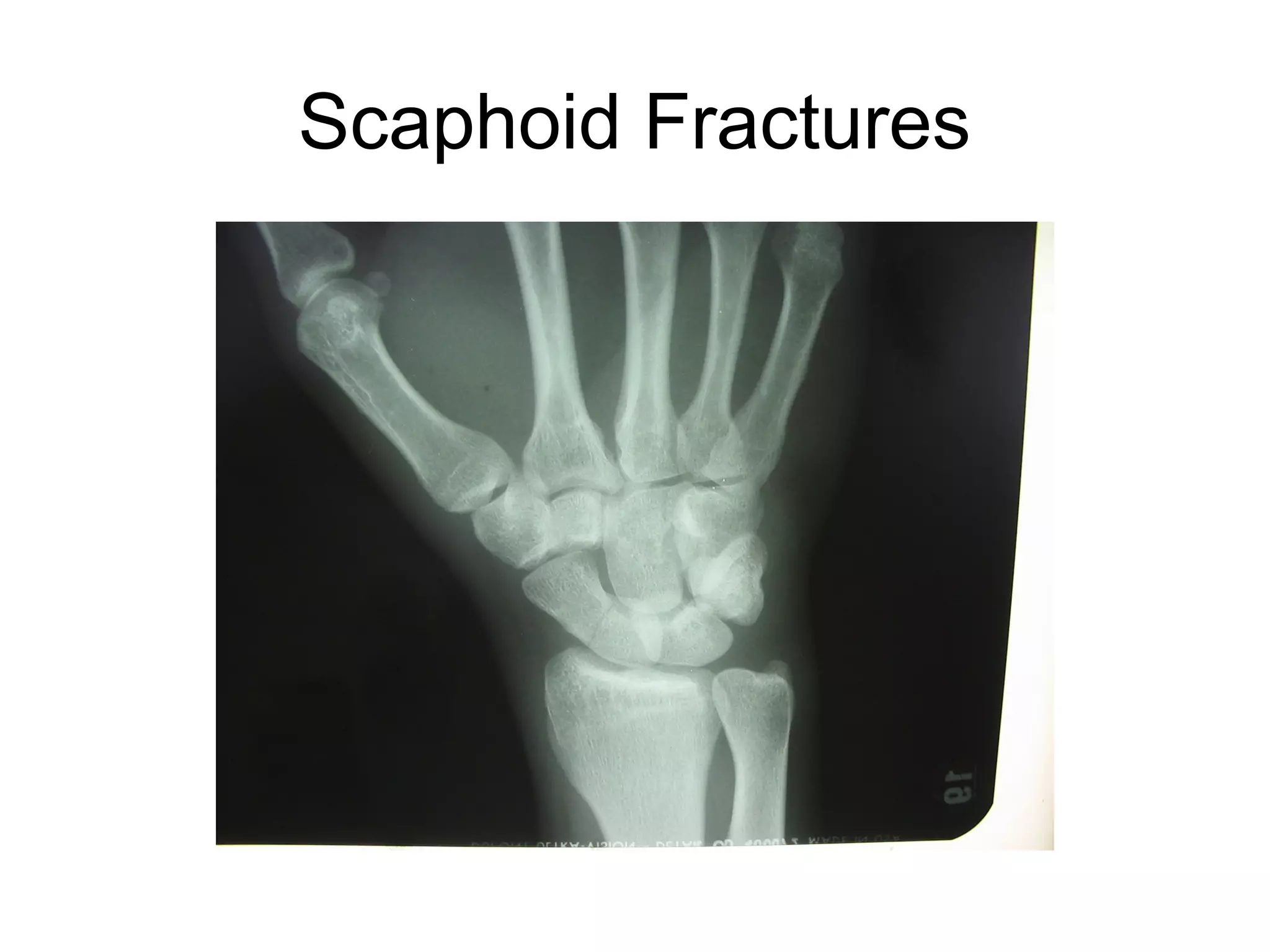 Scaphoid fractures | PPT | Death, Injury, or Military Conflict ...