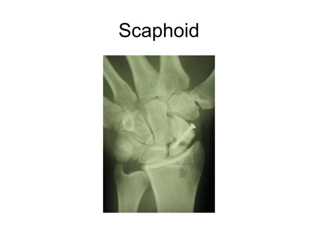Scaphoid fractures | PPT