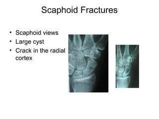 Scaphoid fractures | PPT | Death, Injury, or Military Conflict ...