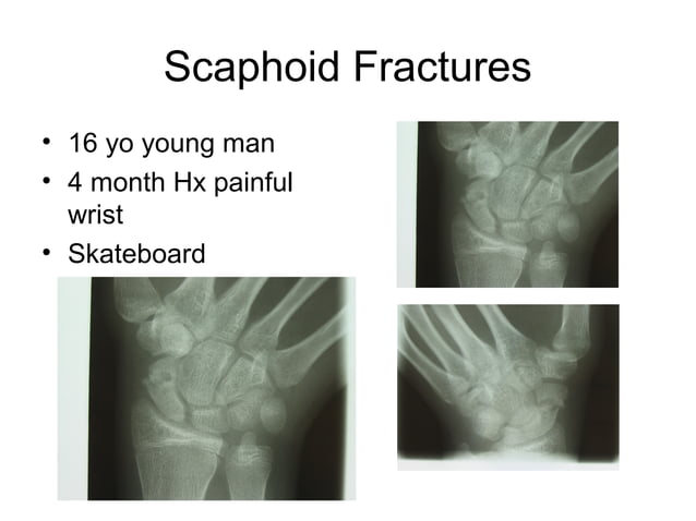 Scaphoid fractures | PPT | Death, Injury, or Military Conflict ...