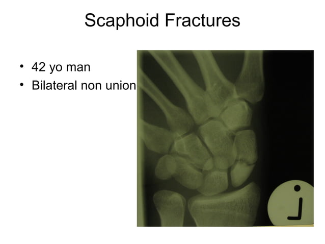 Scaphoid fractures | PPT | Death, Injury, or Military Conflict ...
