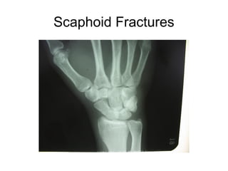 Scaphoid fractures | PPT | Death, Injury, or Military Conflict ...