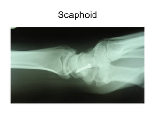 Scaphoid fractures | PPT