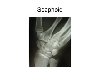 Scaphoid fractures | PPT