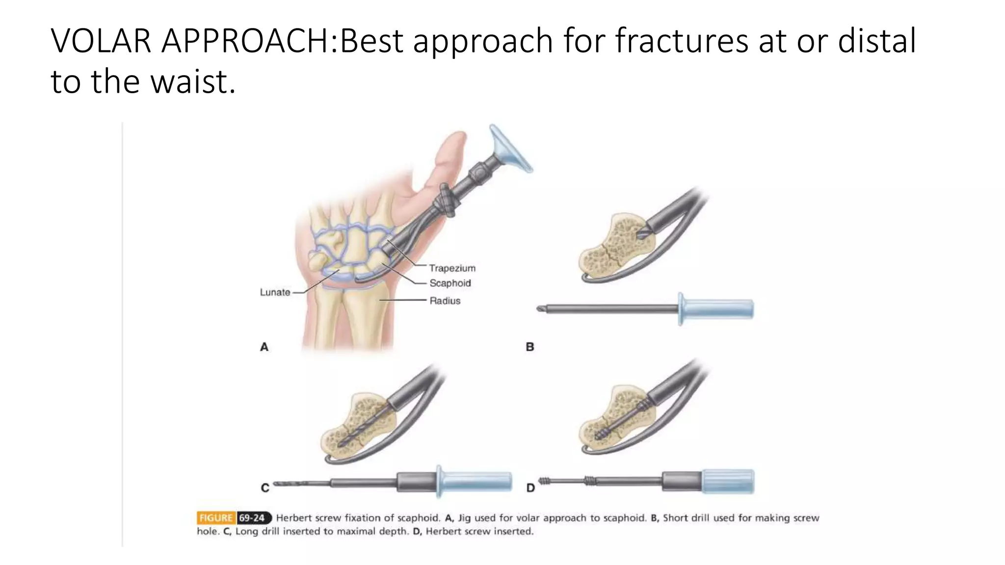 Scaphoid fractures | PPTX