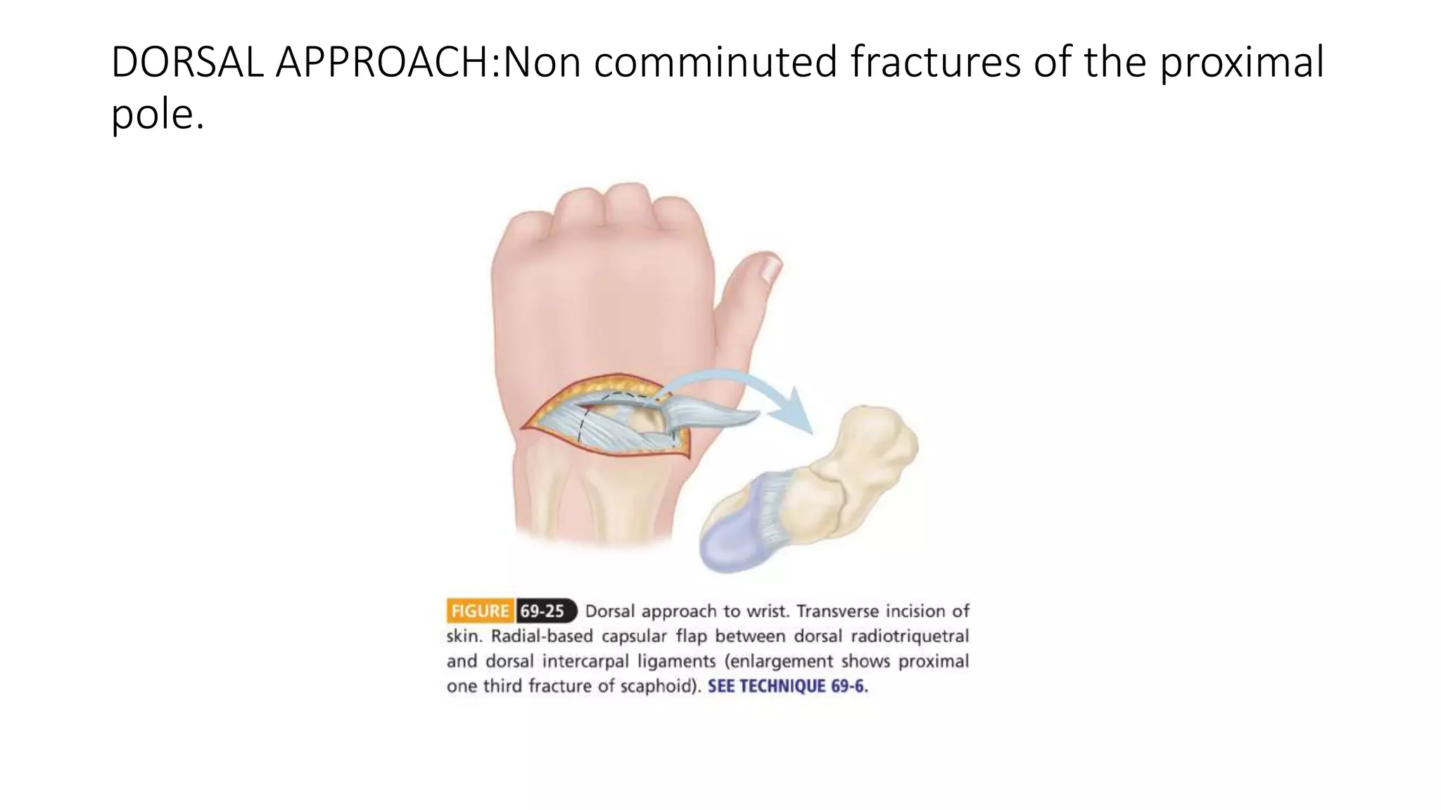 Scaphoid fractures | PPTX
