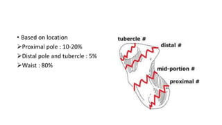 Scaphoid fractures | PPTX