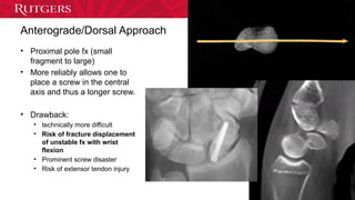 Scaphoid Fractures: Indications and Techniques | PPT