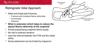 Scaphoid Fractures: Indications and Techniques | PPT