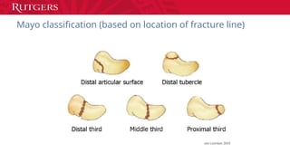Scaphoid Fractures: Indications and Techniques | PPT
