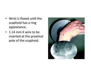 Scaphoid fractures and non union | PPTX
