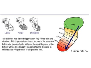 Scaphoid fractures and non union | PPTX