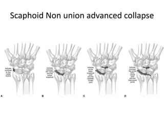 Scaphoid fractures and non union | PPTX