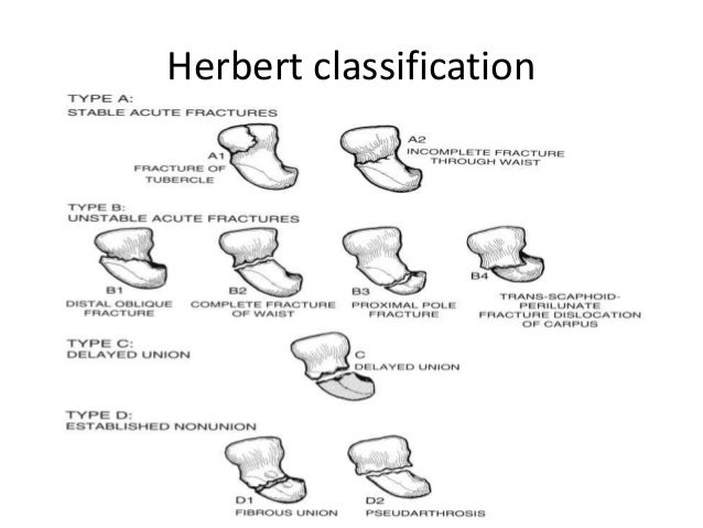 Scaphoid Fracture Classification