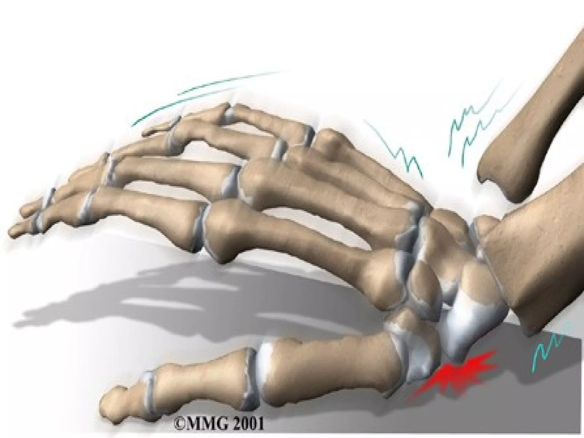 Scaphoid fracturesw | PPT
