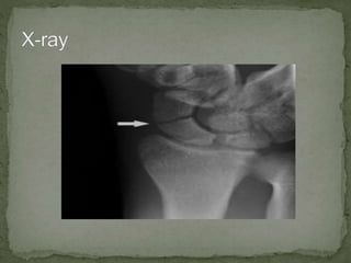 Scaphoid fracture Power Point | PPT