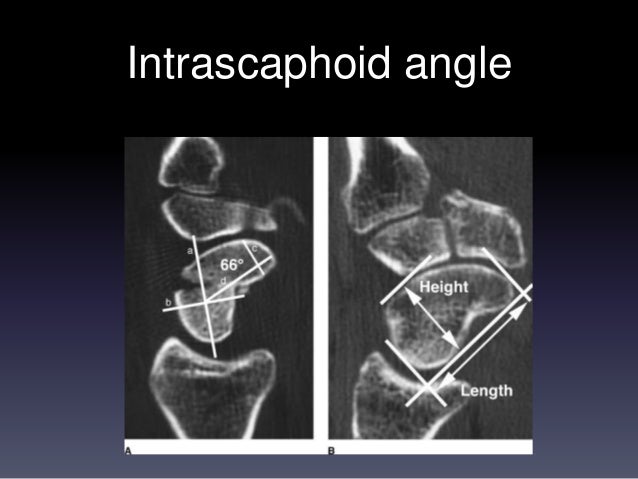 Scaphoid non union- by Hussain Algawahmed