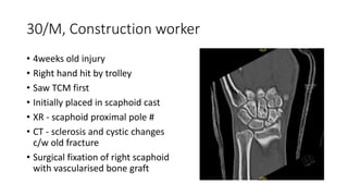 Scaphoid non unions | PPTX