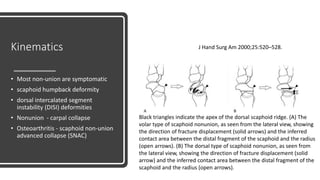 Scaphoid non unions | PPTX