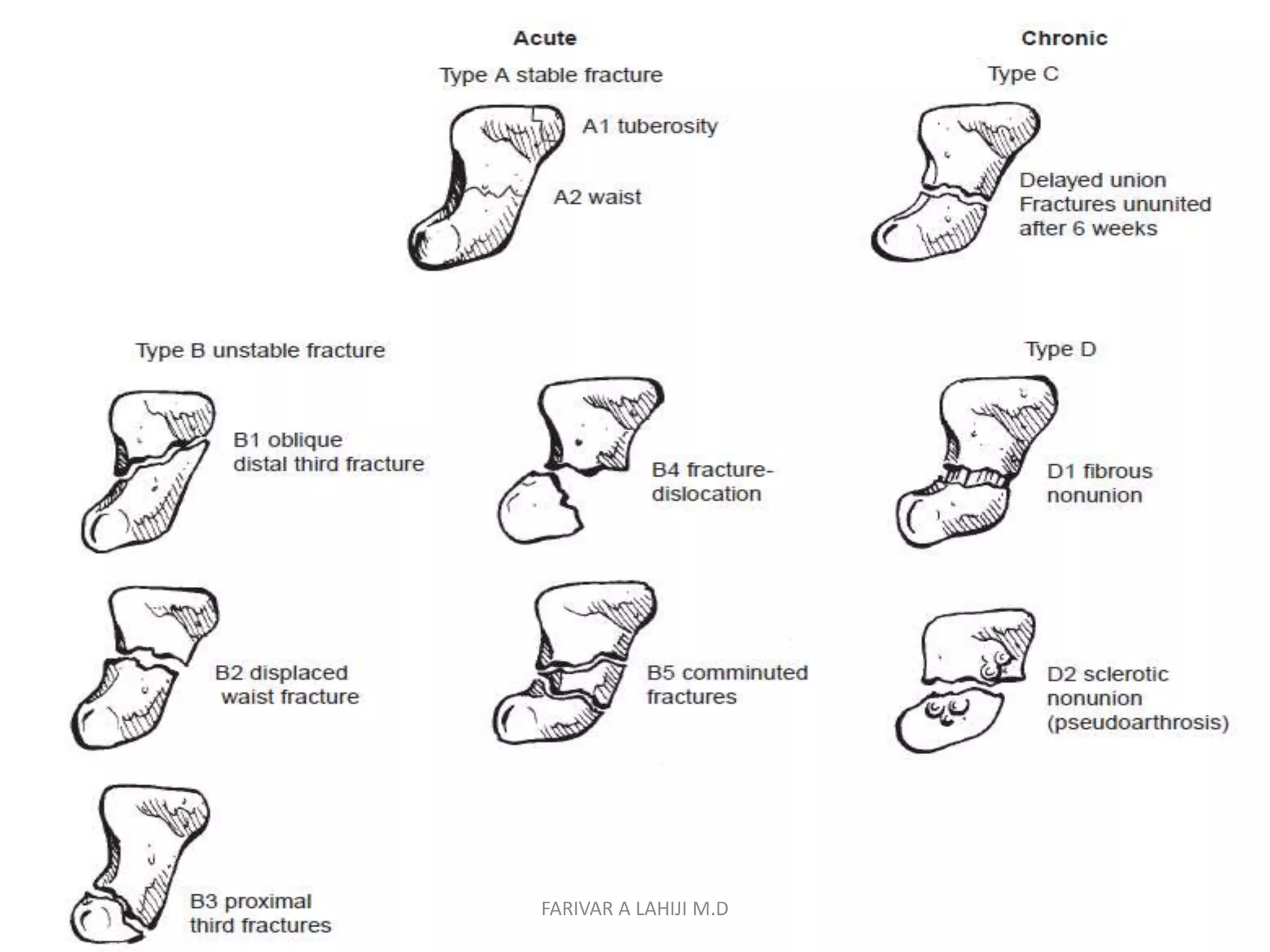 Scaphoid fracture | PPTX