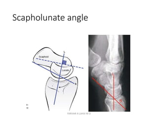 Scaphoid fracture | PPTX