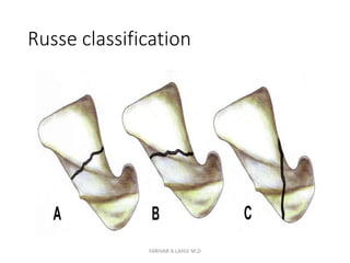 Scaphoid fracture | PPTX