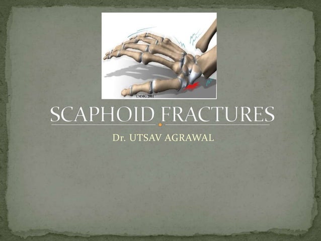 Scaphoid Fractures_UTSAV | PPTX | Death, Injury, or Military Conflict ...