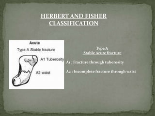 Scaphoid Fractures_UTSAV | PPT