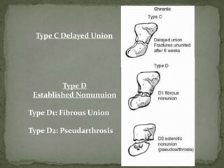 Scaphoid Fractures_UTSAV | PPT