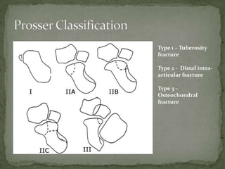 Scaphoid Fractures_UTSAV | PPT