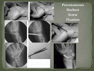 Scaphoid Fractures_UTSAV | PPTX