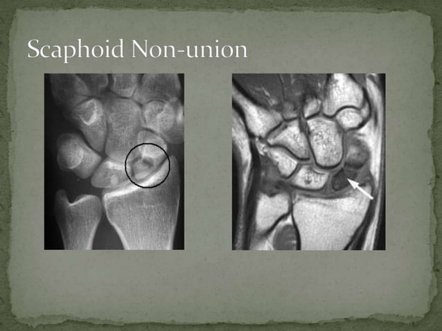 Scaphoid Fractures_UTSAV | PPTX | Death, Injury, or Military Conflict ...