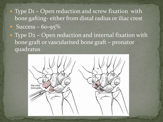 Scaphoid Fractures_UTSAV | PPTX | Death, Injury, or Military Conflict ...