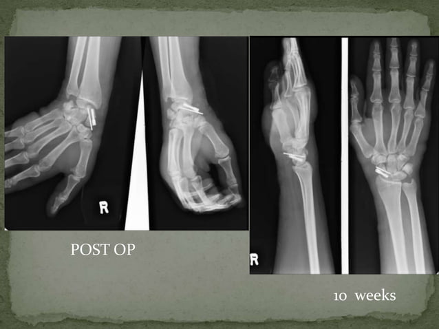Scaphoid Fractures_UTSAV | PPTX | Death, Injury, or Military Conflict ...
