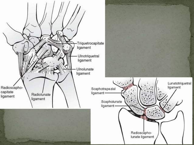Scaphoid Fractures_UTSAV | PPTX | Death, Injury, or Military Conflict ...