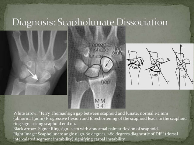 Scapholunate dissociation (1) | PPTX | Death, Injury, or Military ...