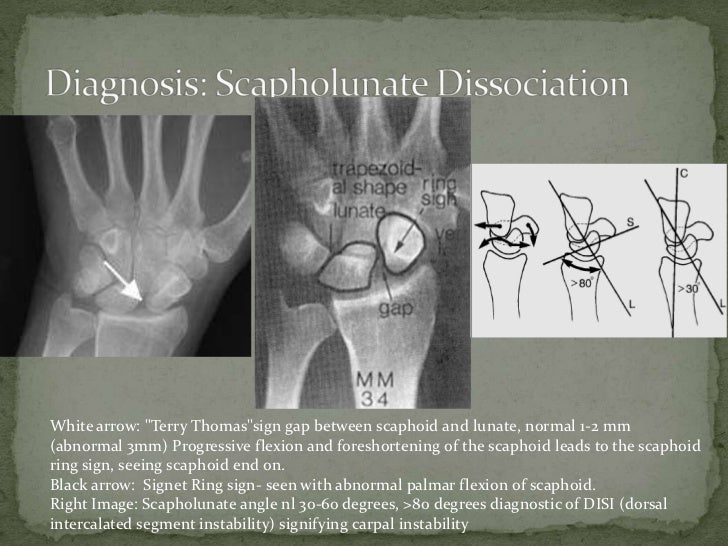 Scapholunate dissociation (1)
