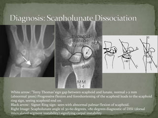 Scapholunate dissociation Power Point | PPTX