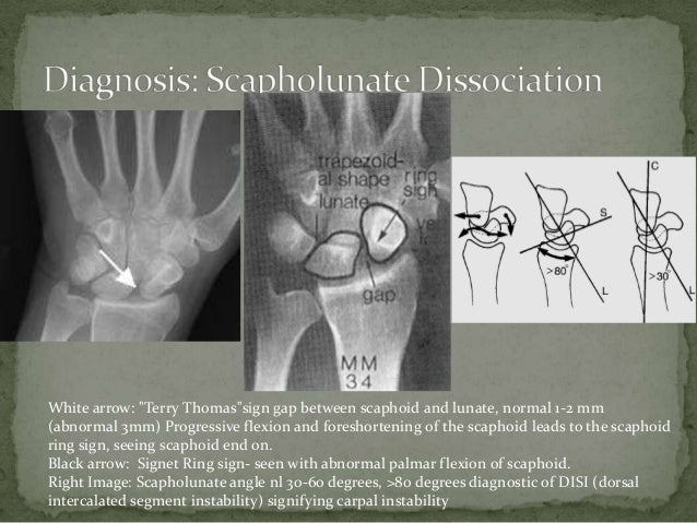 Scapholunate dissociation Power Point