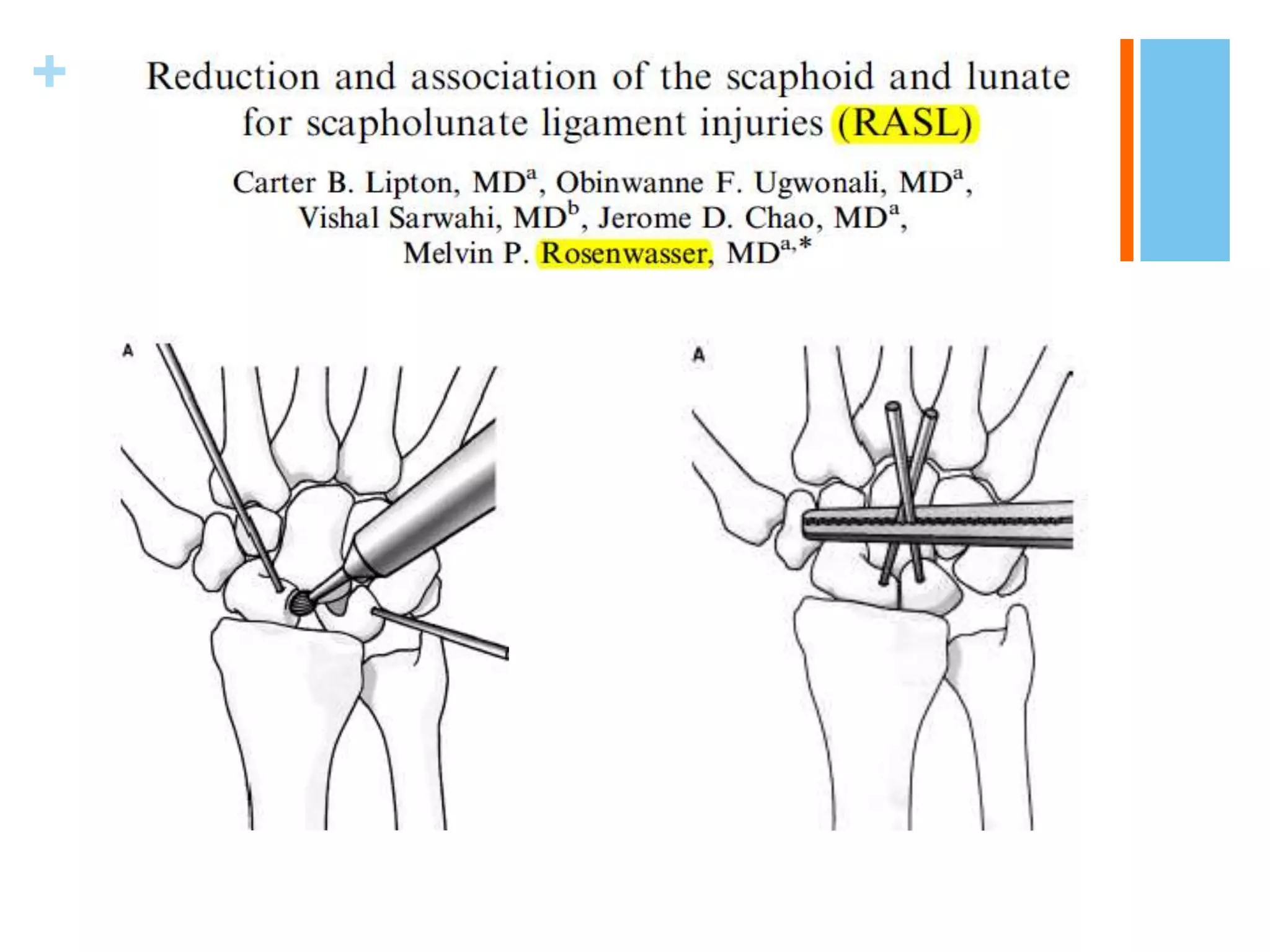 Scapholunate injuries part 2 - by Hussain Algawahmed | PPTX