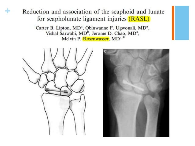 Scapholunate injuries part 2 - by Hussain Algawahmed | PPTX