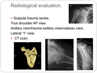 Scapula fracture diagnosis and management | PPTX