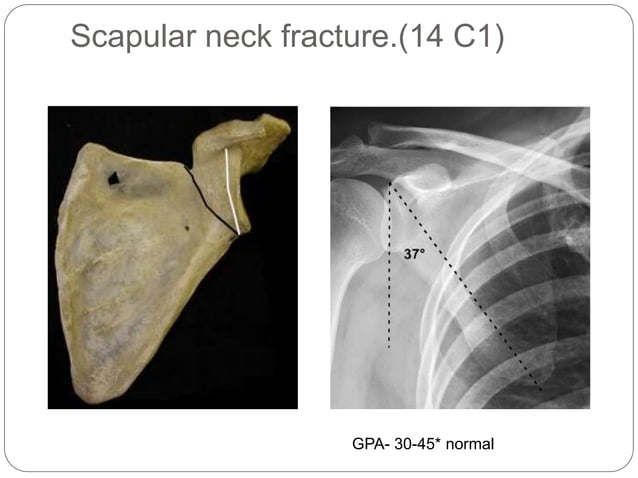 Scapula fracture diagnosis and management | PPTX