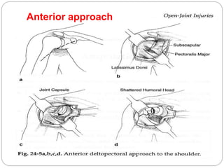 Scapula fracture diagnosis and management | PPTX